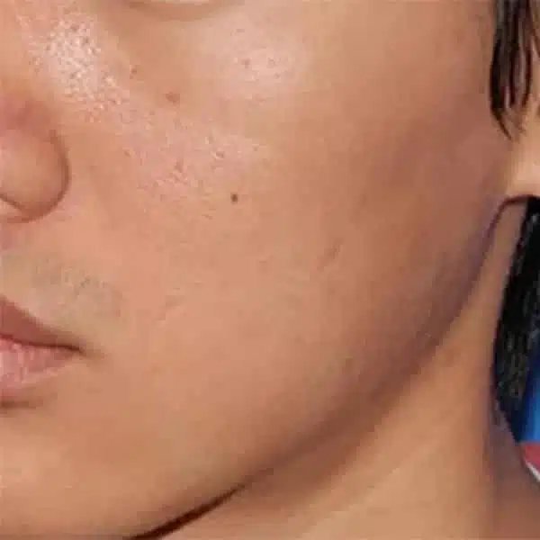 Microneedling Treatment NYC, Houston, Miami | Skinney