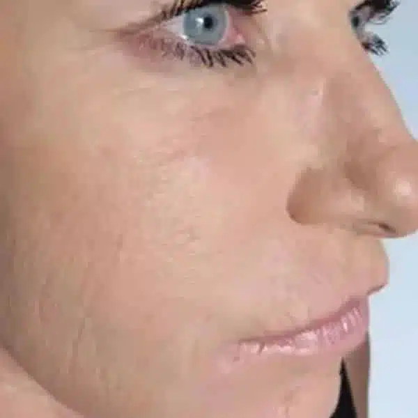 Microneedling Treatment NYC, Houston, Miami | Skinney