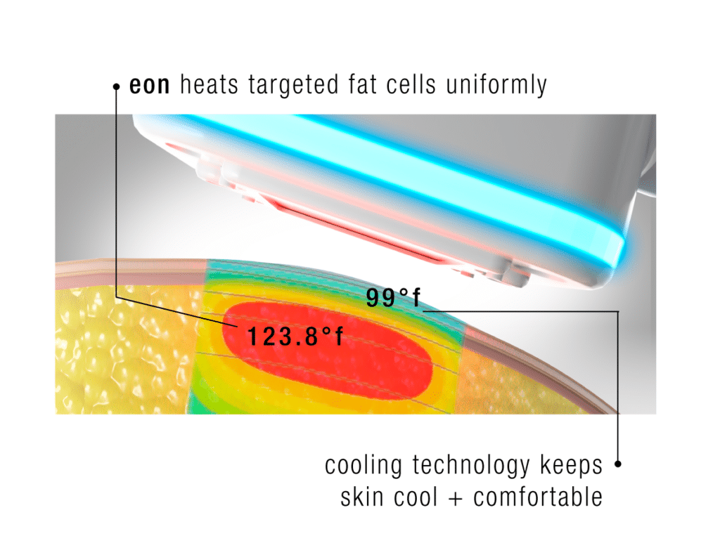 EON Laser NYC | Body Sculpting Before & After | 20% Off Cost