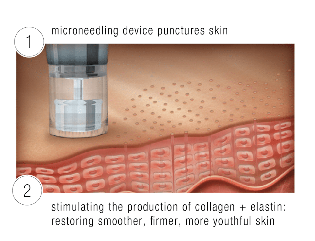 Microneedling Treatment NYC, Houston, Miami | Skinney