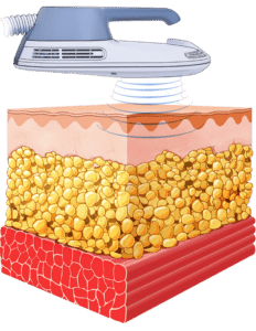 Emsculpt Miami | Body Sculpting Before & After | $500 Off