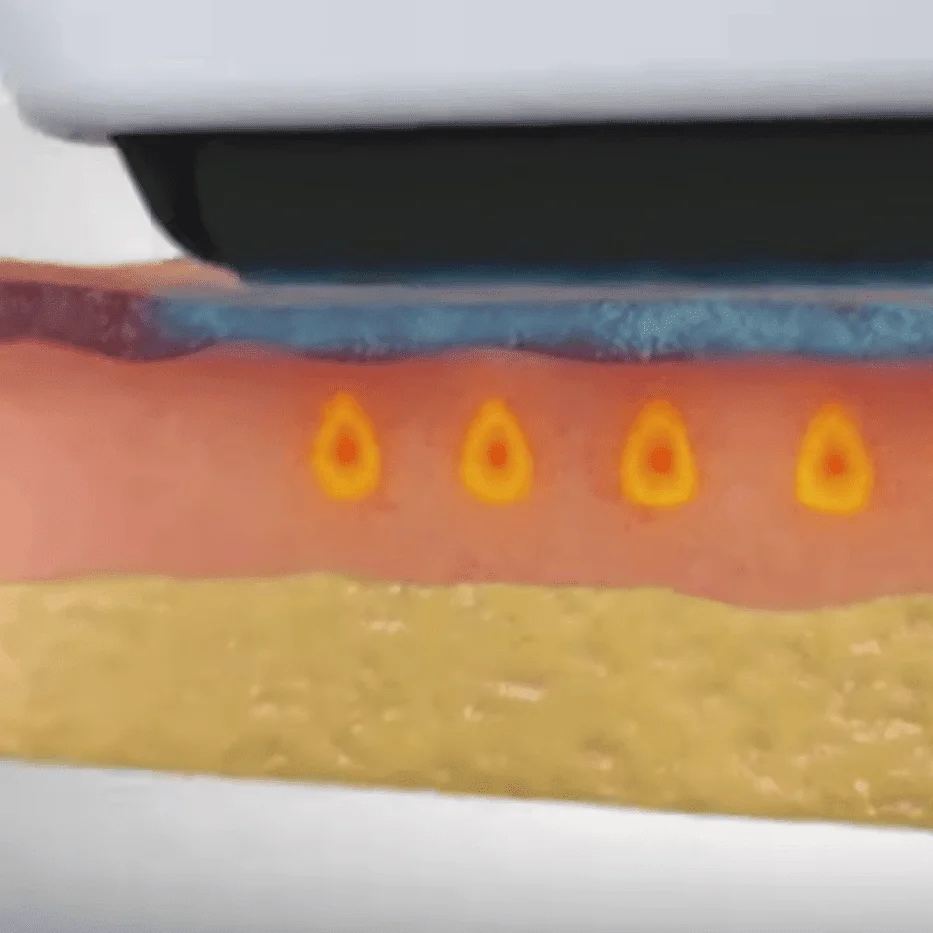 Sofwave NYC | Non-Invasive Face & Neck Tightening | 20% Off