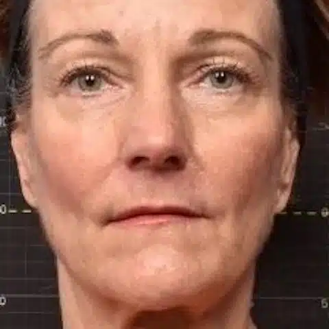 Sofwave NYC | Non-Invasive Face & Neck Tightening | 20% Off