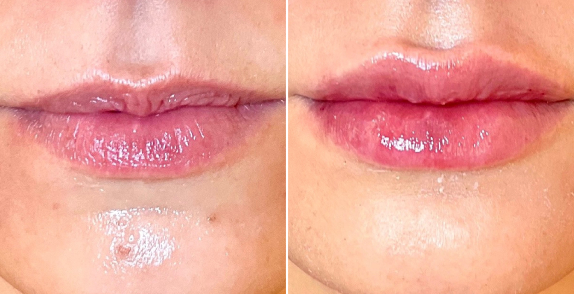 Natural-Looking Plump Pout With Botox Lip Flip In NYC | SKINNEY Medspa