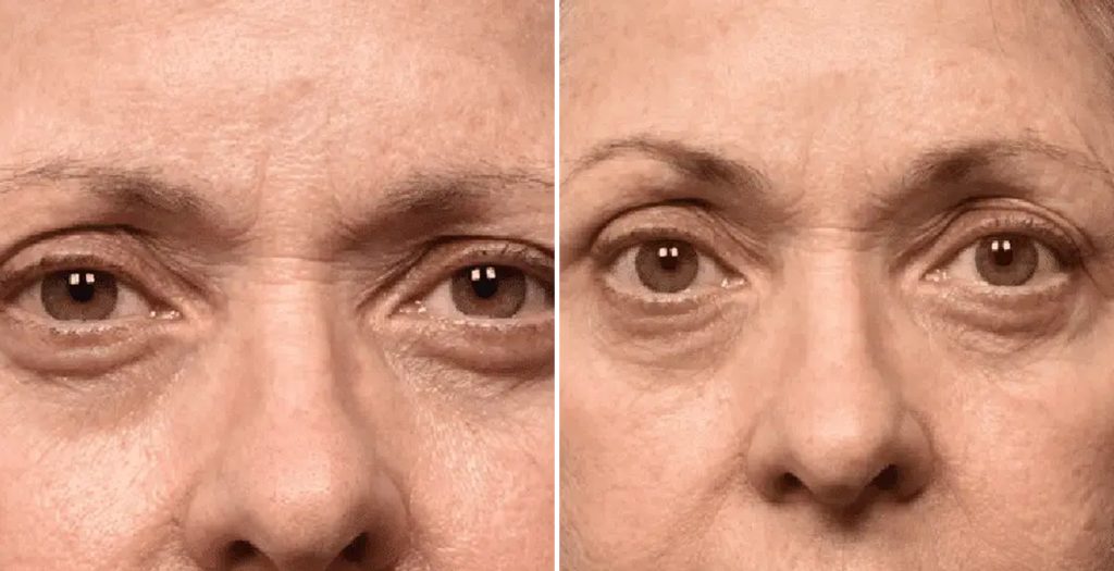 Sofwave NYC | Non-Invasive Face & Neck Tightening | 20% Off